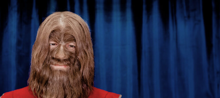 Werewolf Syndrome: The Story of Hypertrichosis - Docquity