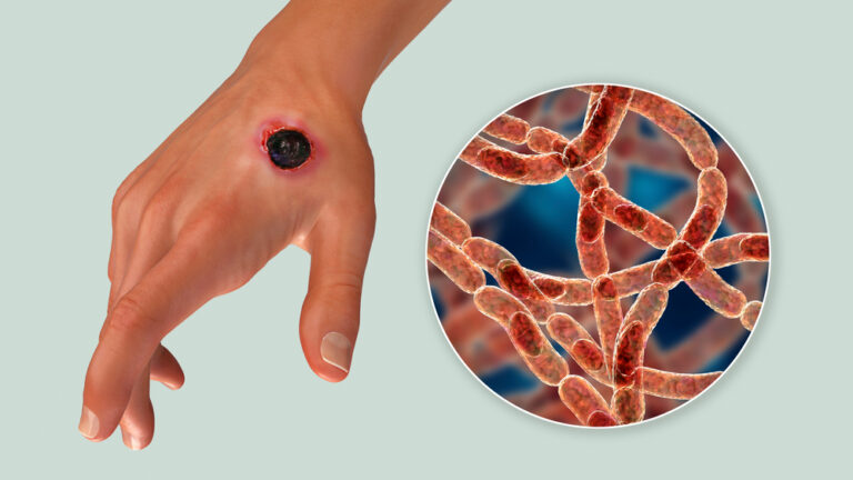 CDC Guidelines Unveiled: Safeguarding Against Anthrax with Prevention ...