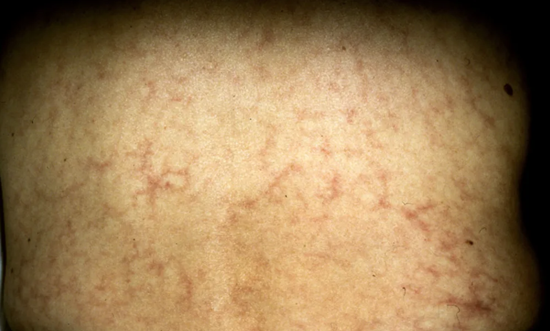 Bridging Dermatology and Neurology: Exploring the Complexities of ...