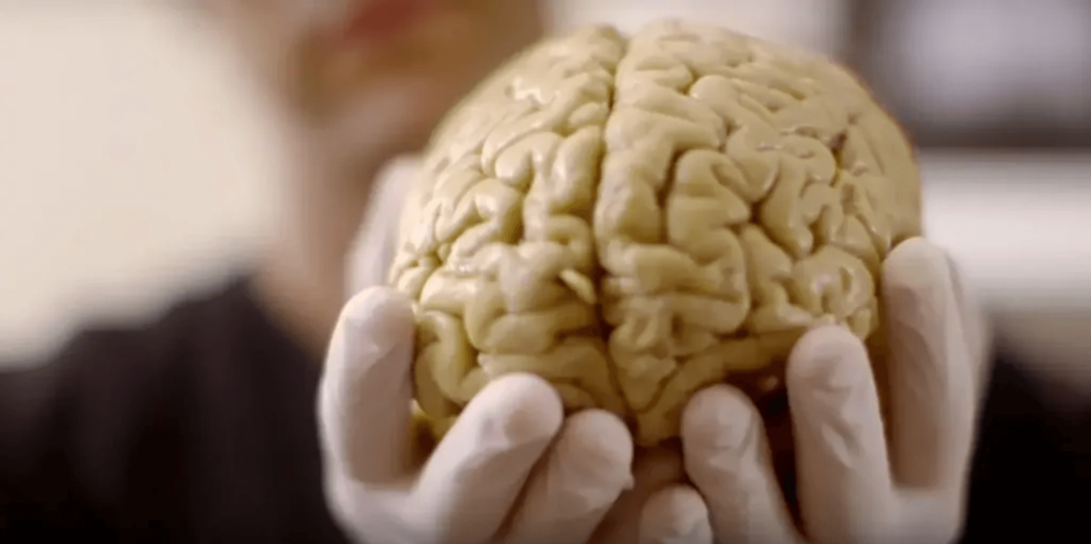 Neurology Case: A Man Living with 90% of His Brain Missing