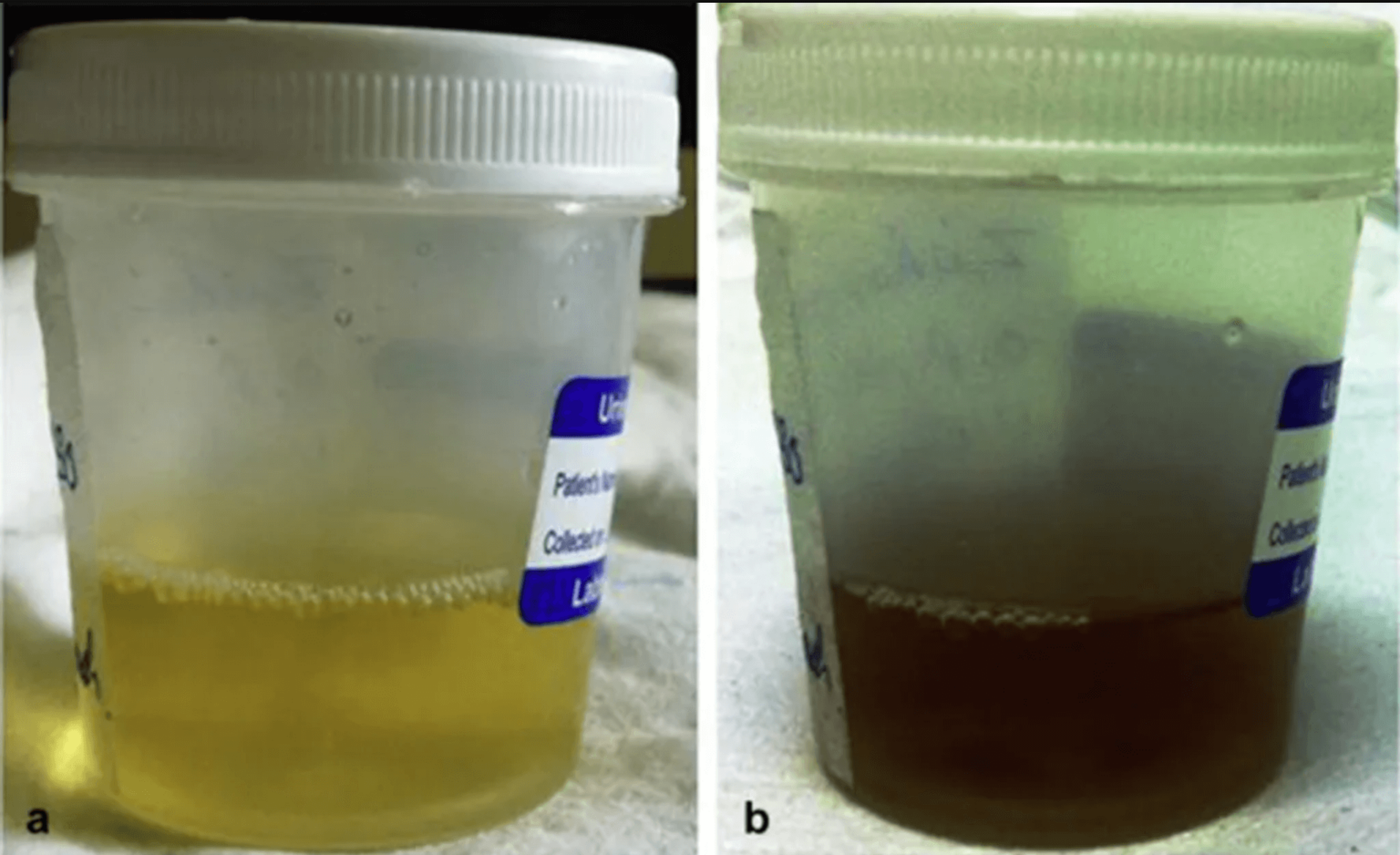 Black Urine Disease: A Complex Condition